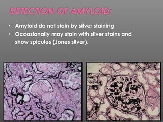 Renal amyloidosis | PPT
