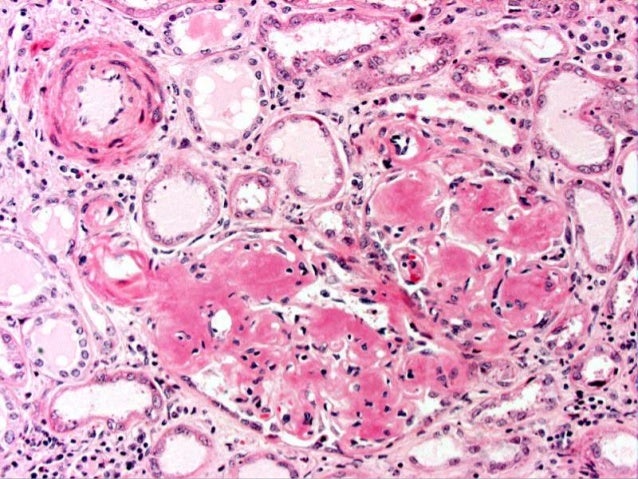 Renal amyloidosis