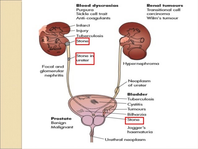 Renal and bladder stones by Sunil Kumar Daha