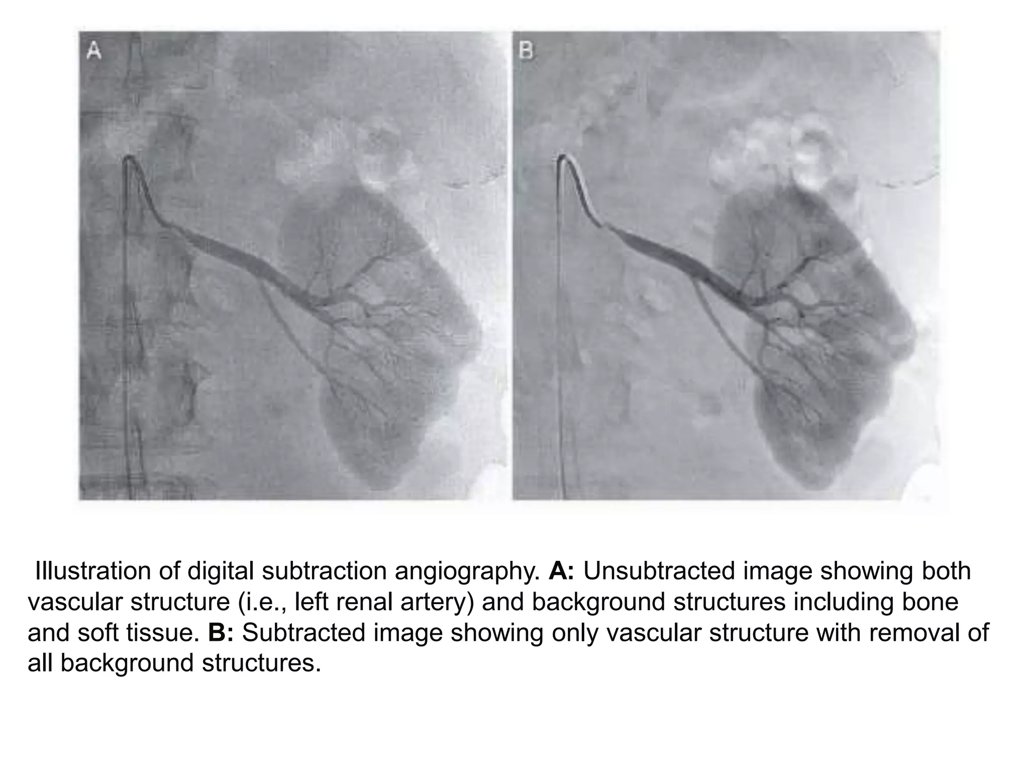 Renal Angiography | PPTX