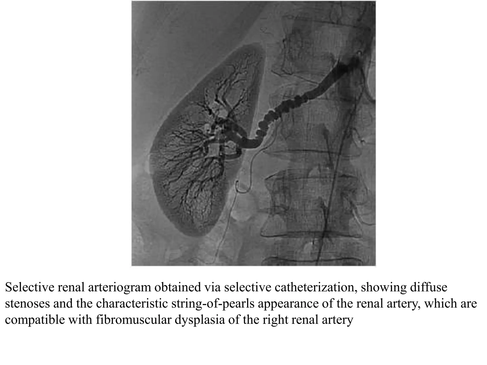 Renal Angiography | PPTX