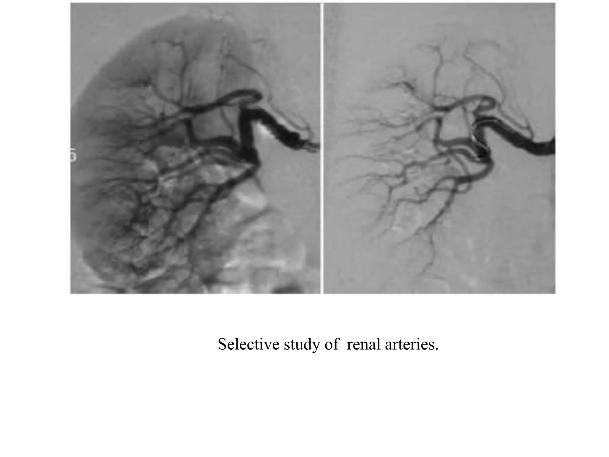 Renal Angiography | PPTX