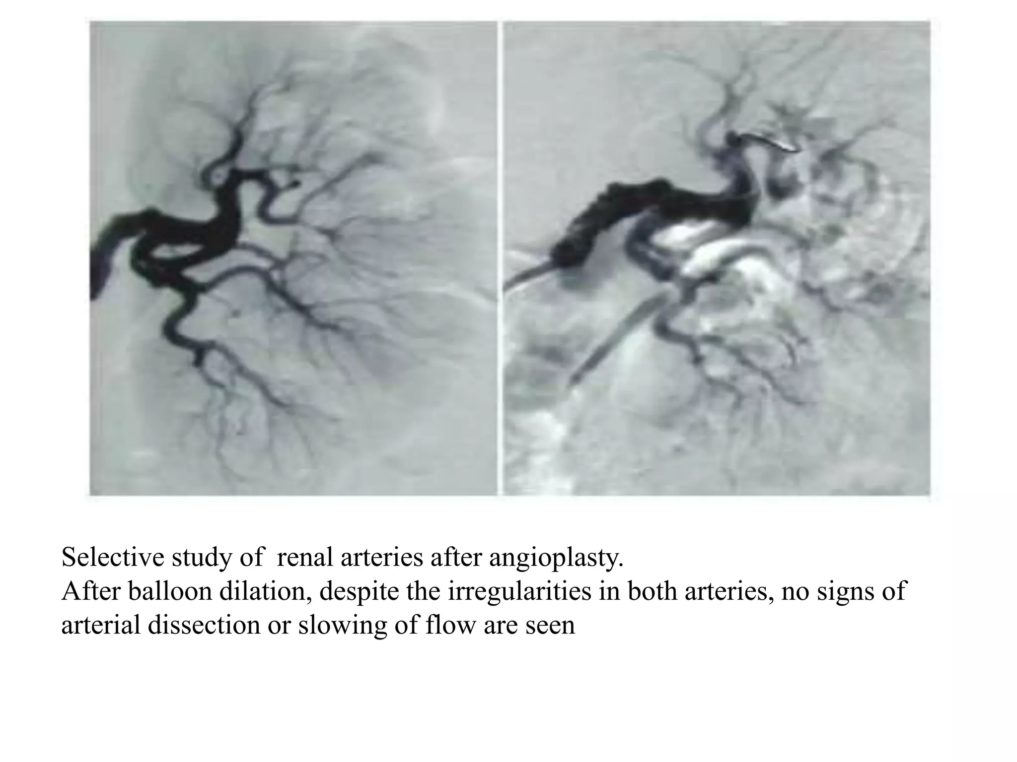 Renal Angiography | PPTX