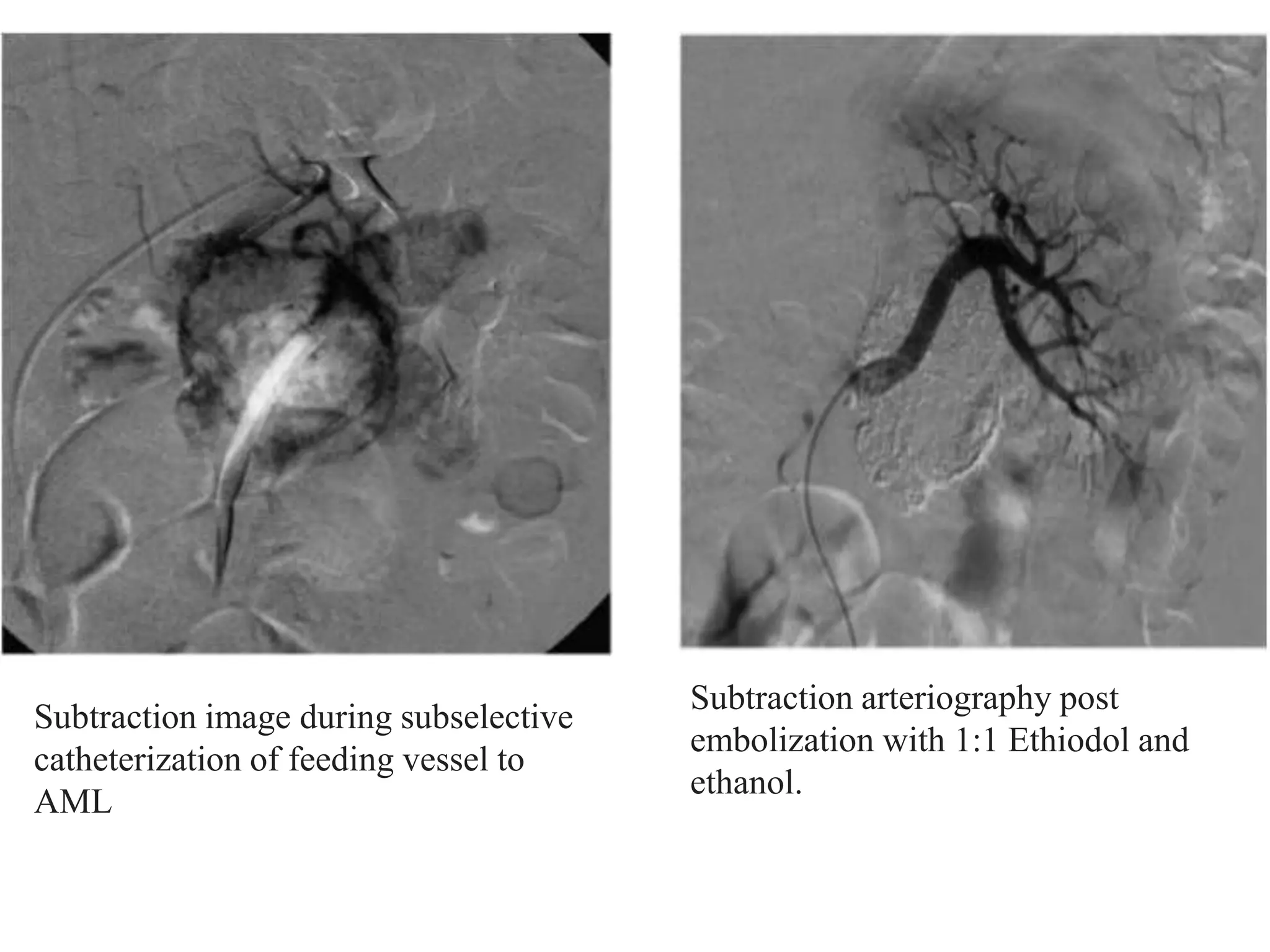 Renal Angiography | PPTX