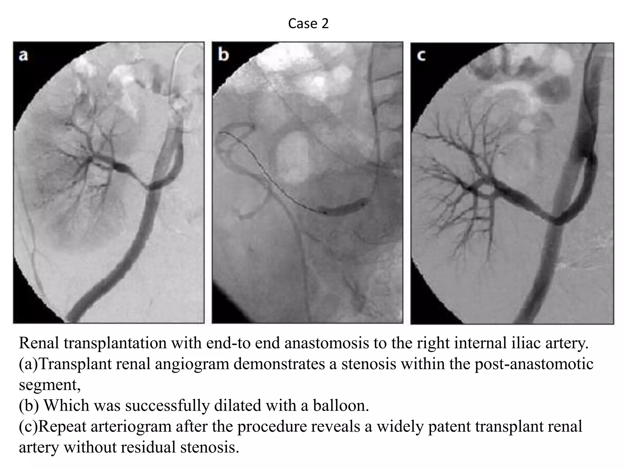 Renal Angiography | PPTX