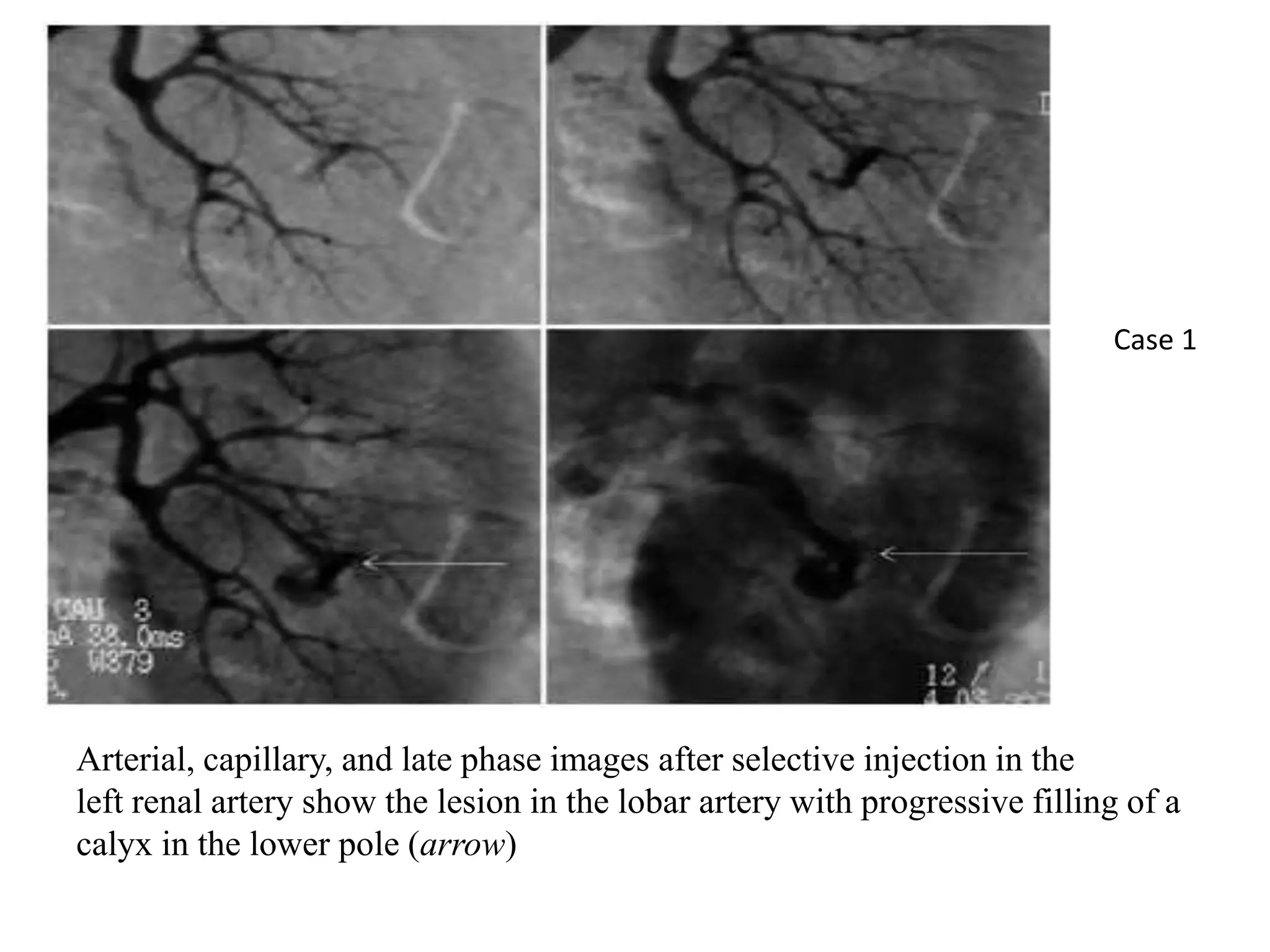 Renal Angiography | PPTX
