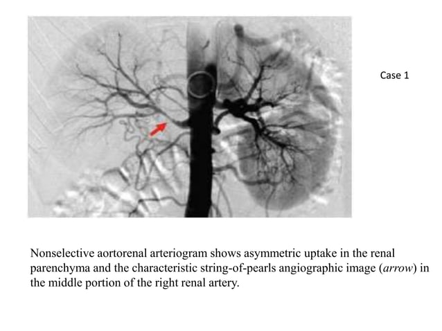 Renal Angiography | PPTX | Medical Tests | Medical Health