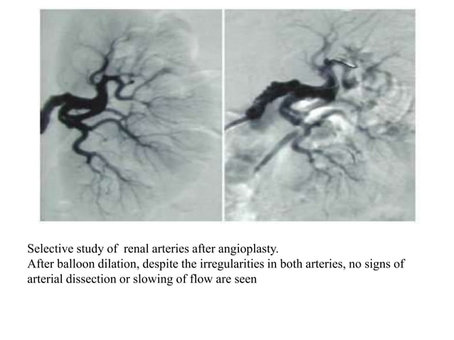 Renal Angiography | PPTX | Medical Tests | Medical Health