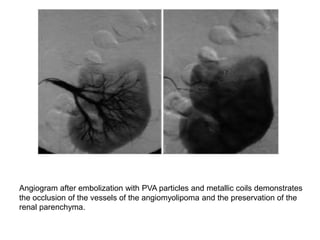Renal Angiography | PPTX