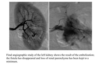 Renal Angiography | PPTX