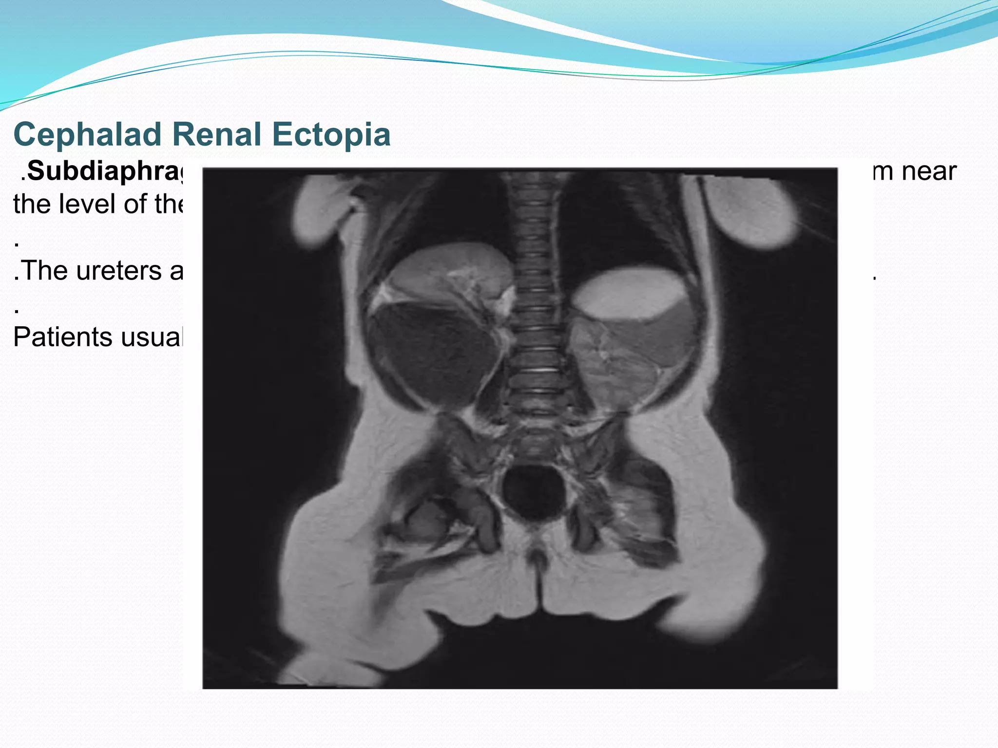 Renal anomalies | PPTX