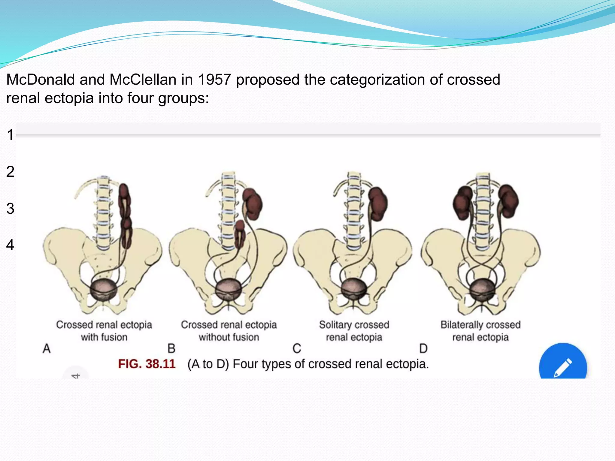 Renal anomalies | PPTX