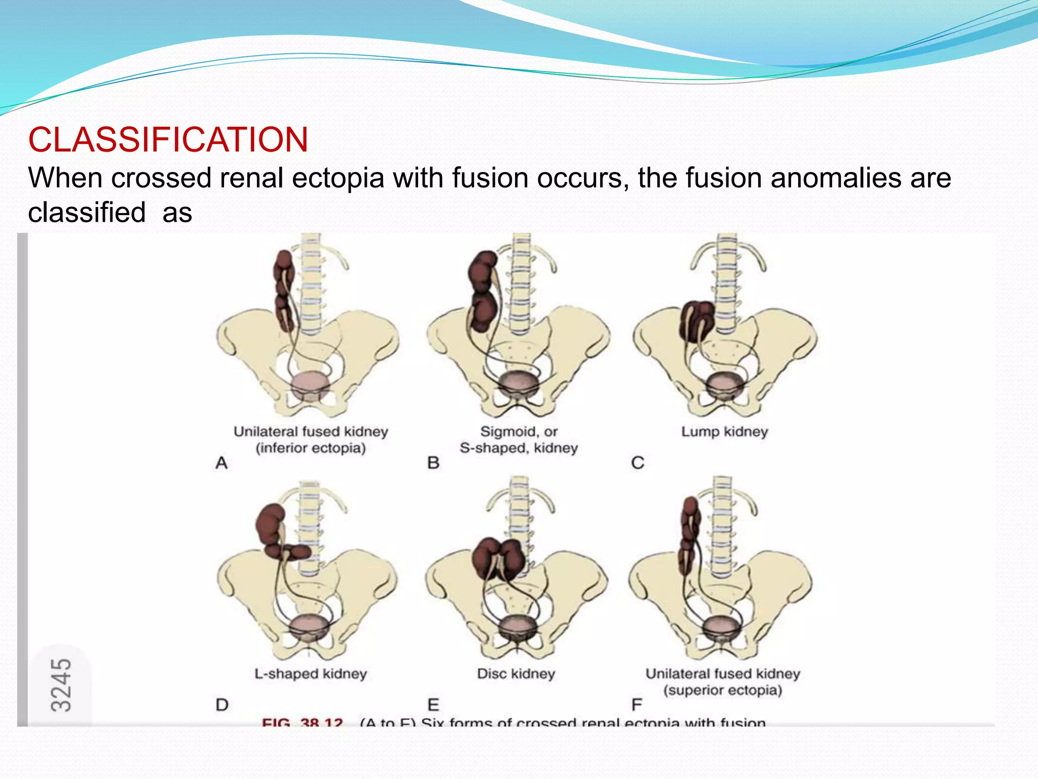 Renal anomalies | PPTX