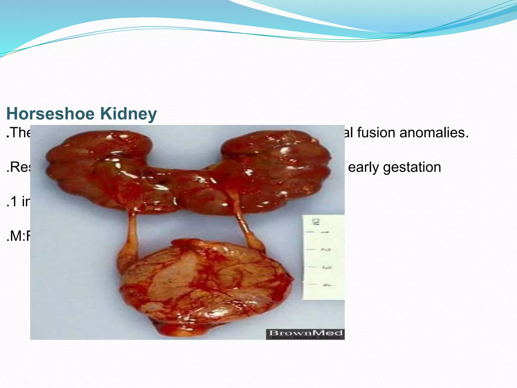 Renal anomalies | PPTX