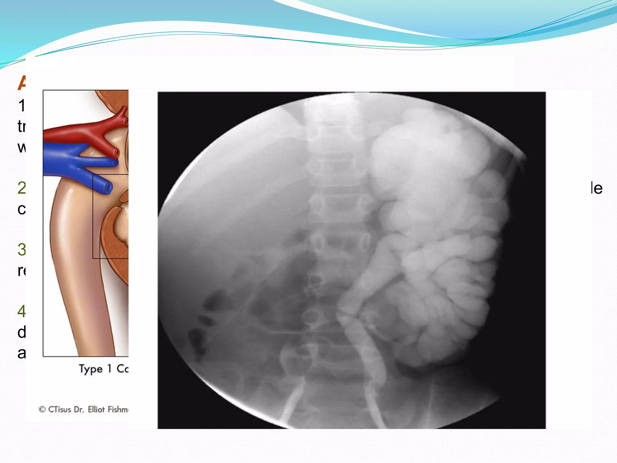 Renal anomalies | PPTX
