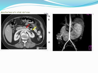 Renal anomalies | PPTX