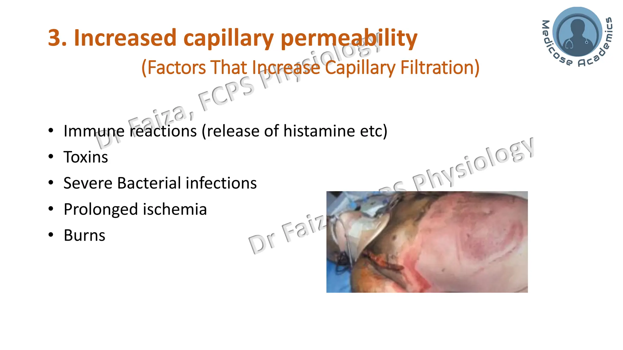 Extracellular Edema, types and pathophysiology | PDF