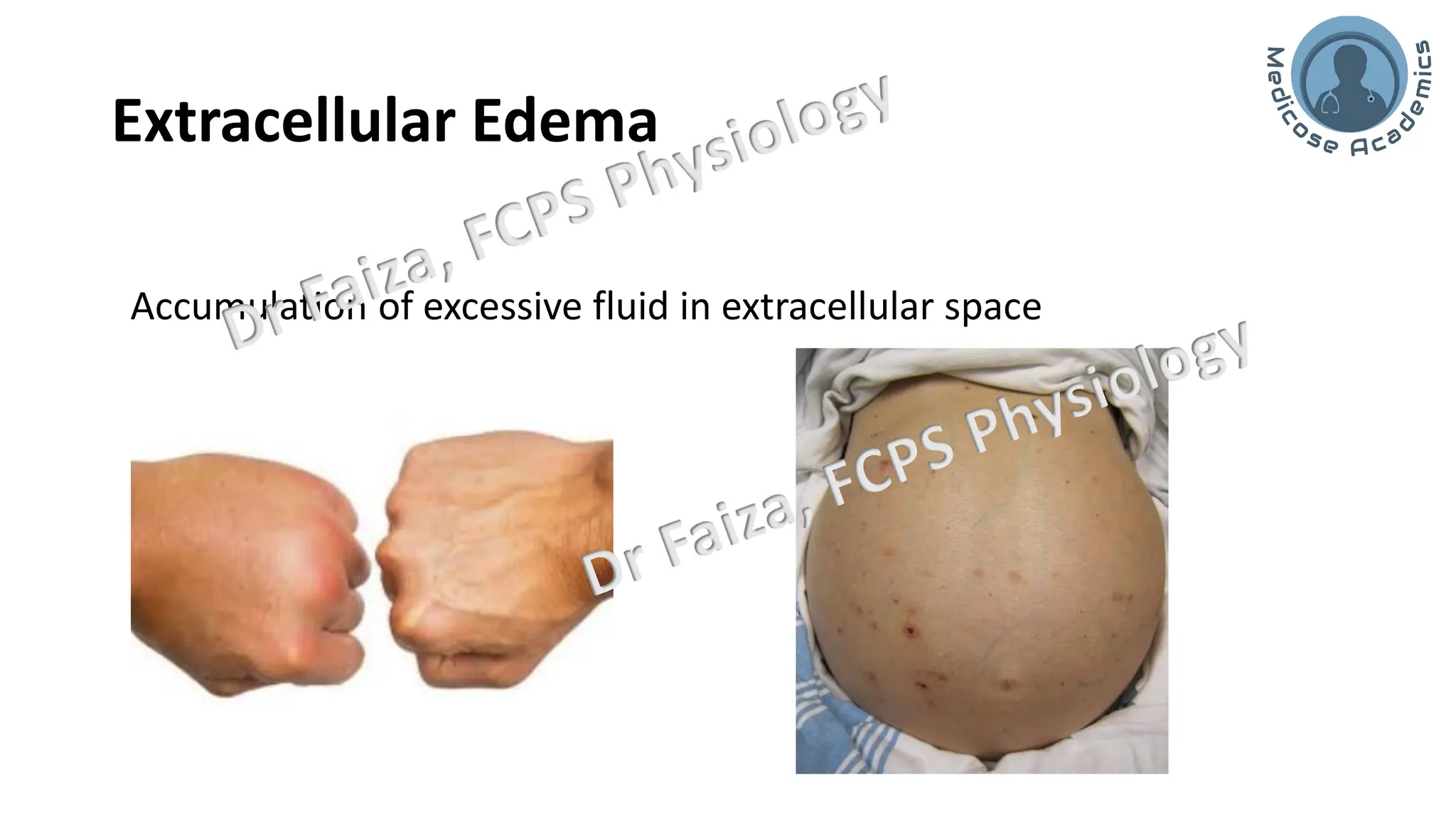 Extracellular Edema, types and pathophysiology | PDF