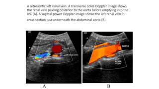 Renal artery Doppler and renal transplant | PPTX