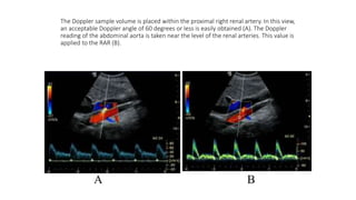 Renal artery Doppler and renal transplant | PPTX