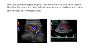 Renal artery Doppler and renal transplant | PPTX