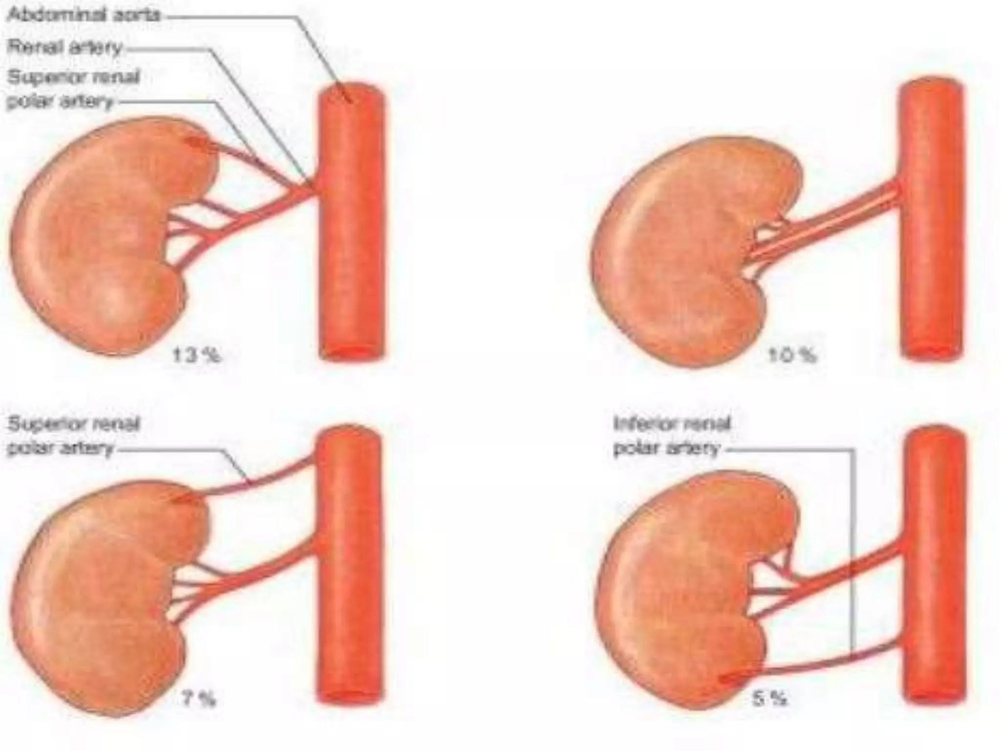 Renal artery variation in renal transplantation | PPTX