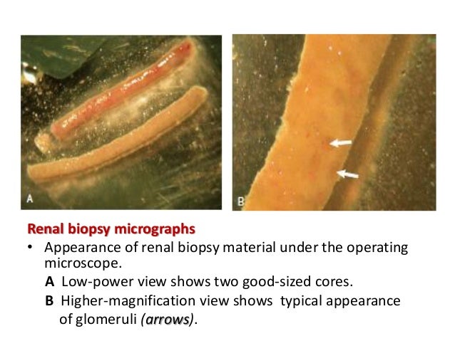 Renal biopsy