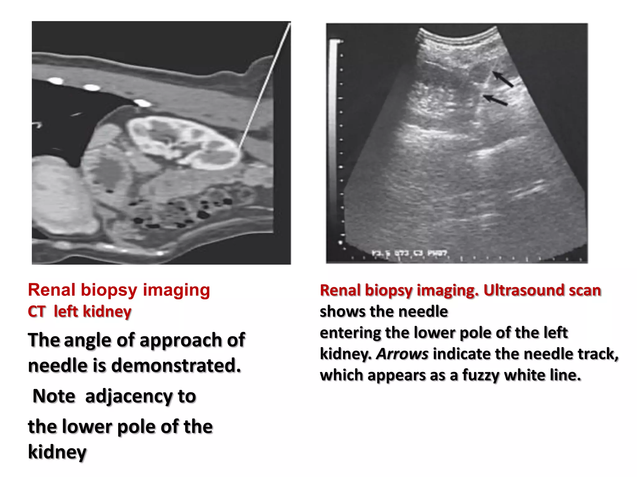 Renal biopsy | PDF
