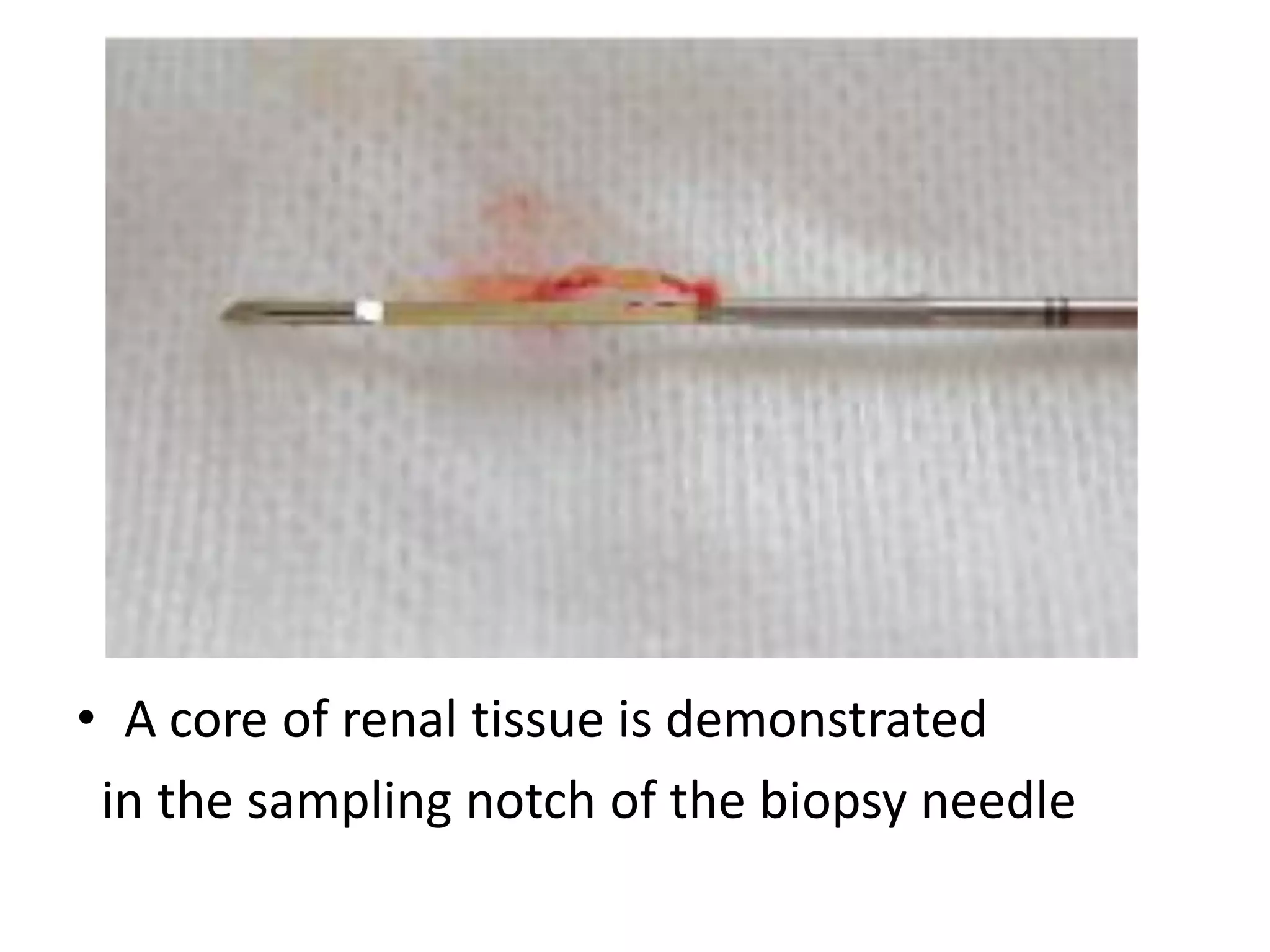 Renal biopsy | PDF