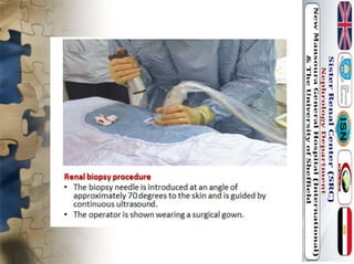 Renal biopsy, nadia | PPTX