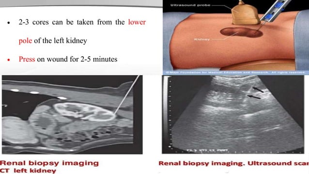 ultrasound guided renal biopsy.pptx