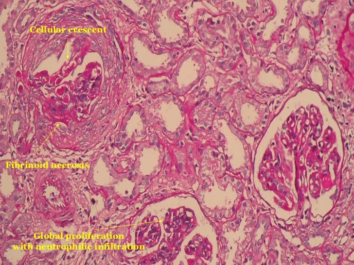 Renal biopsy seminar