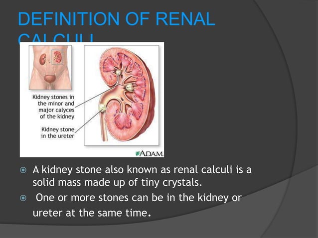 Renal calculi | PPT