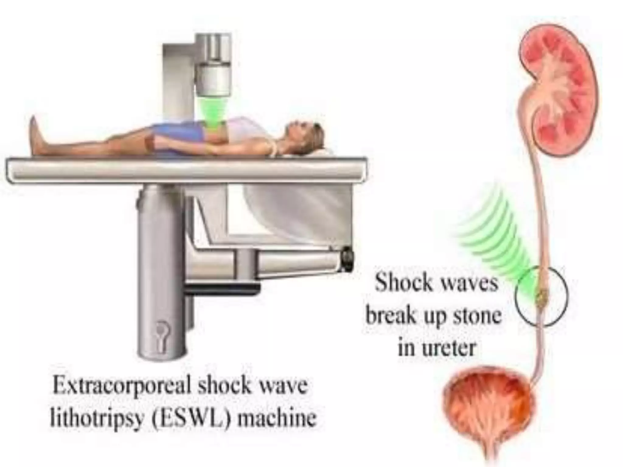 Renal calculi | PPTX