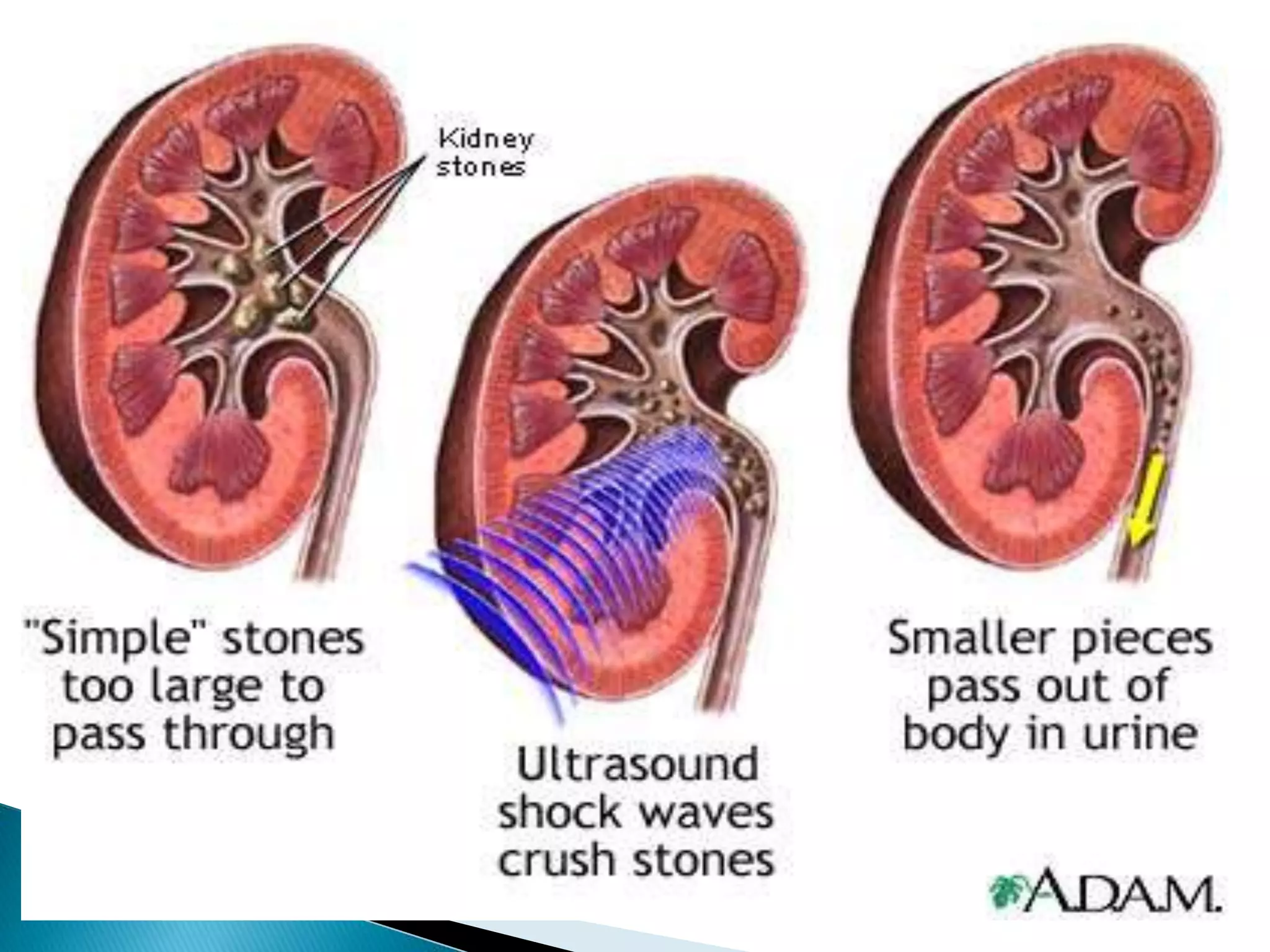 Renal calculi | PPTX