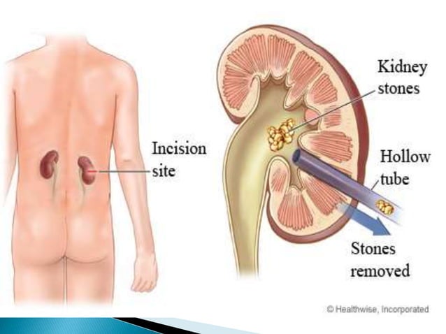 Renal calculi | PPTX