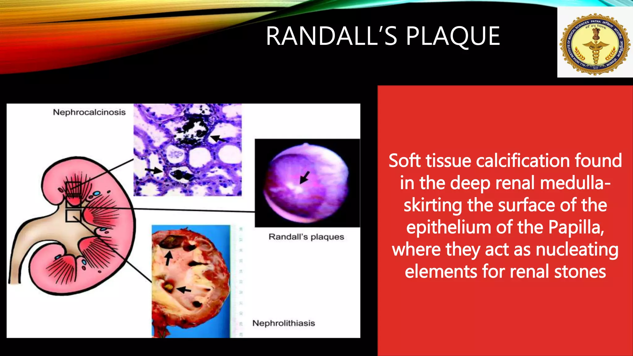 Renal stone by Dr Anil Kumar, Assistant Professor, AIIMS-Patna | PPTX