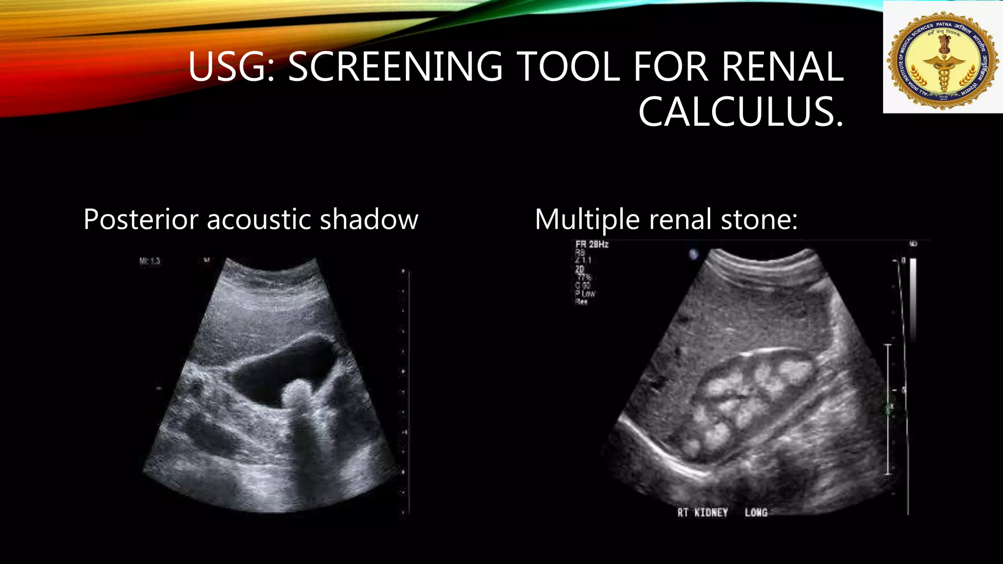 Renal stone by Dr Anil Kumar, Assistant Professor, AIIMS-Patna | PPTX