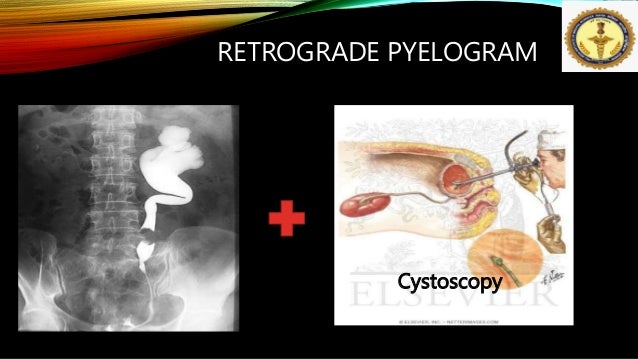 Renal stone by Dr Anil Kumar, Assistant Professor, AIIMS-Patna