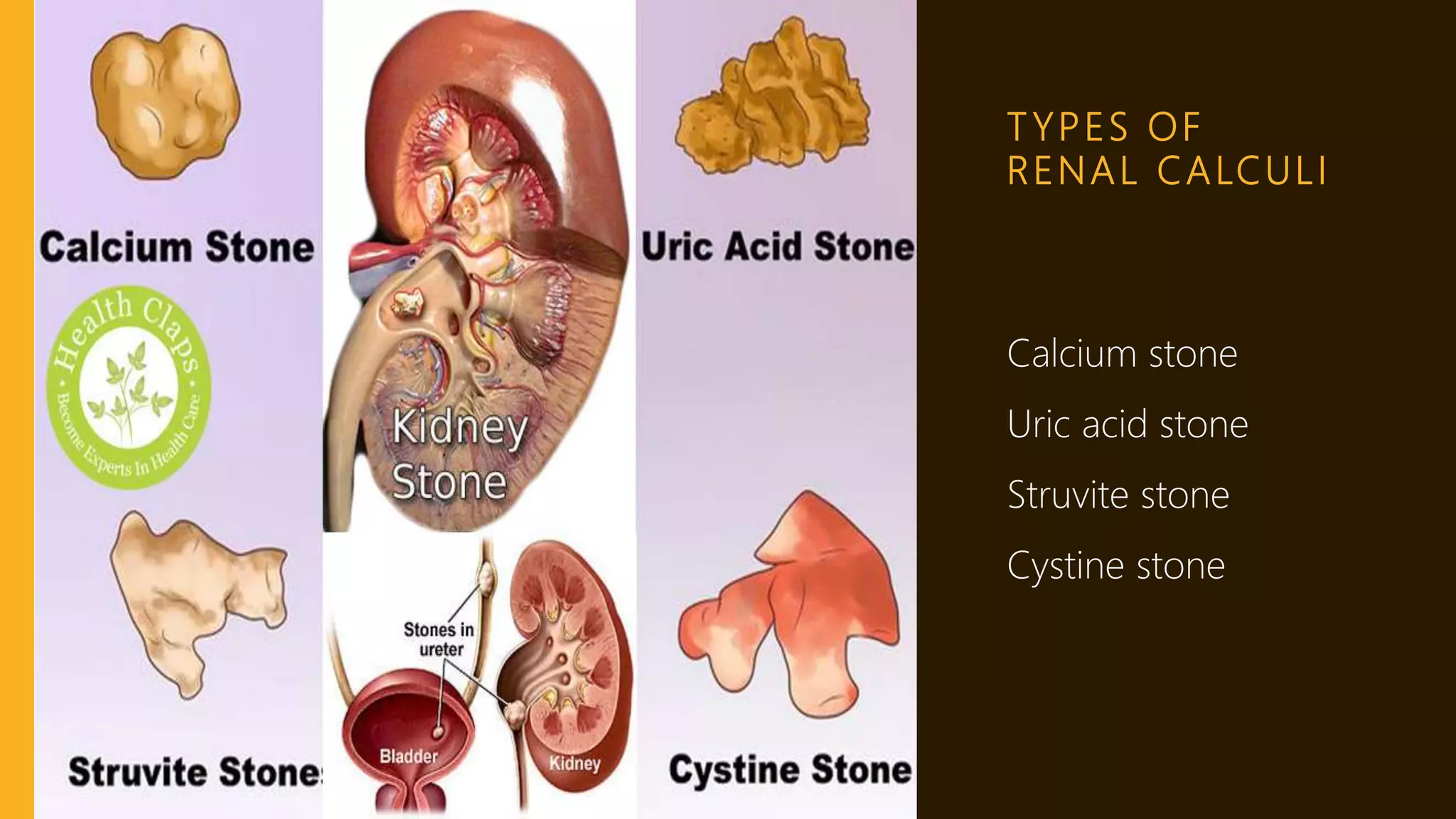 Renal calculi | PPTX