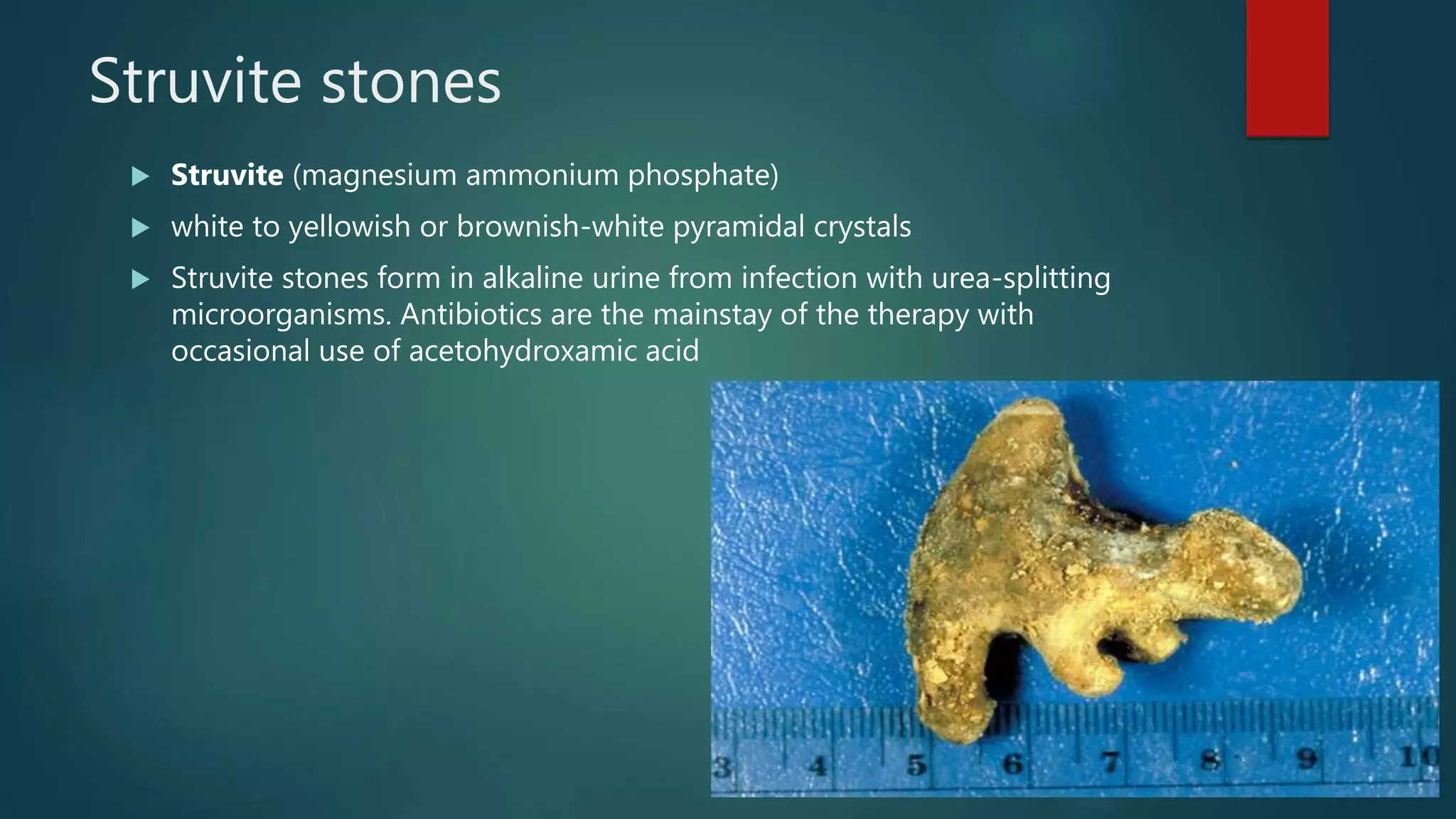 Renal calculi (nursing ppt) | PPTX