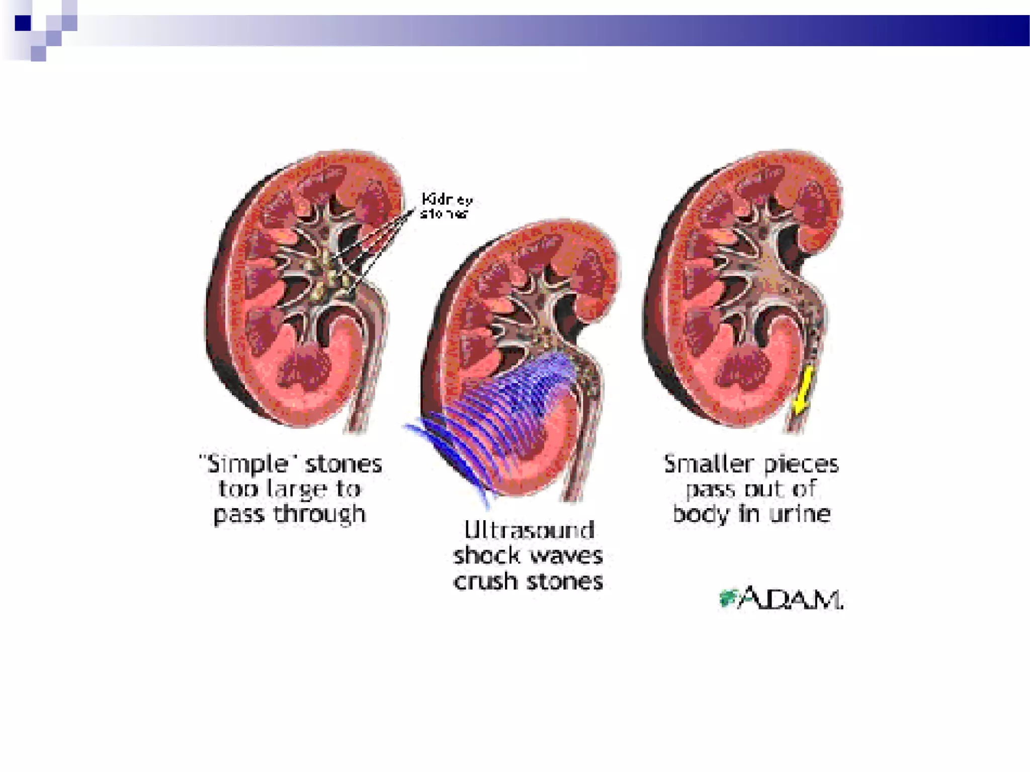 Renal calculi | PPT