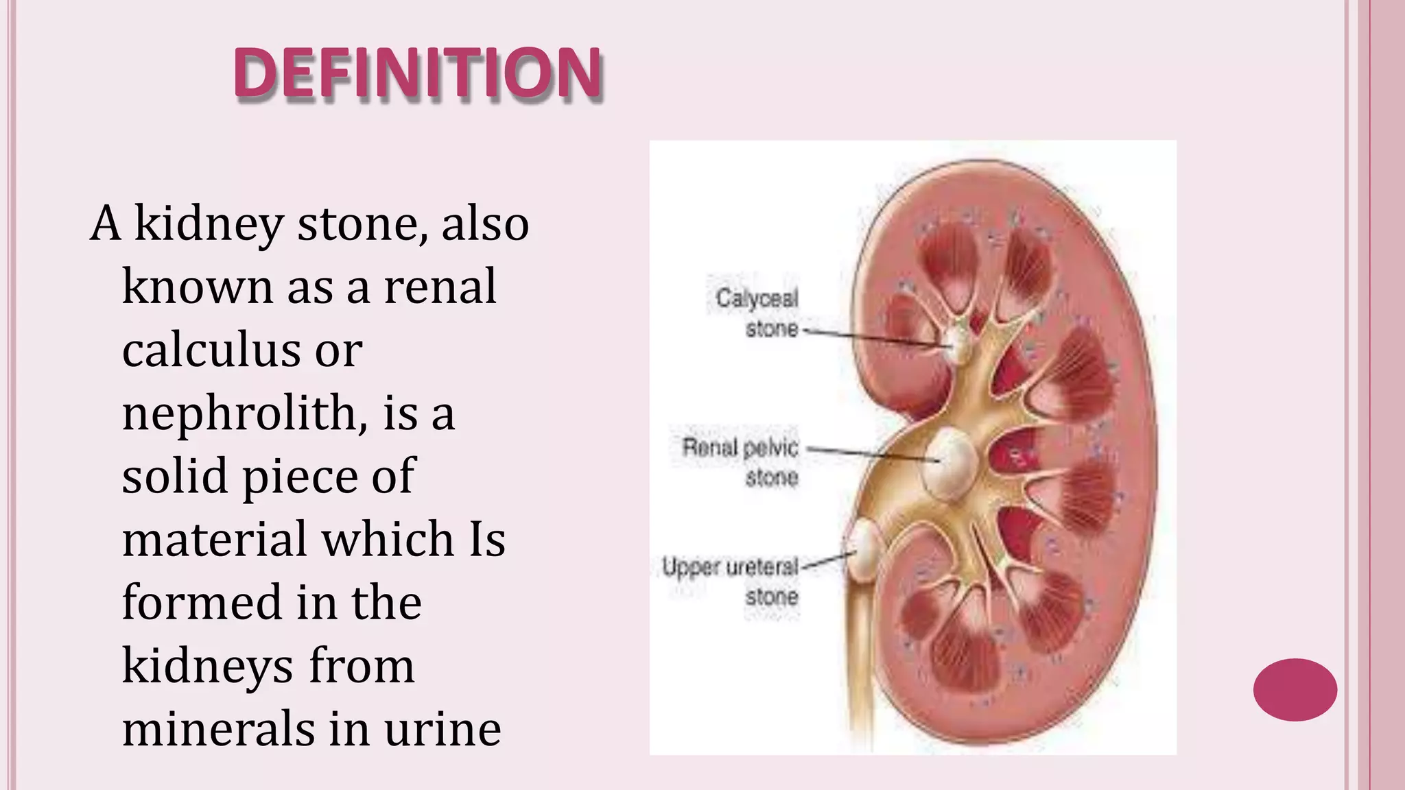 RENAL CALCULI | PPTX