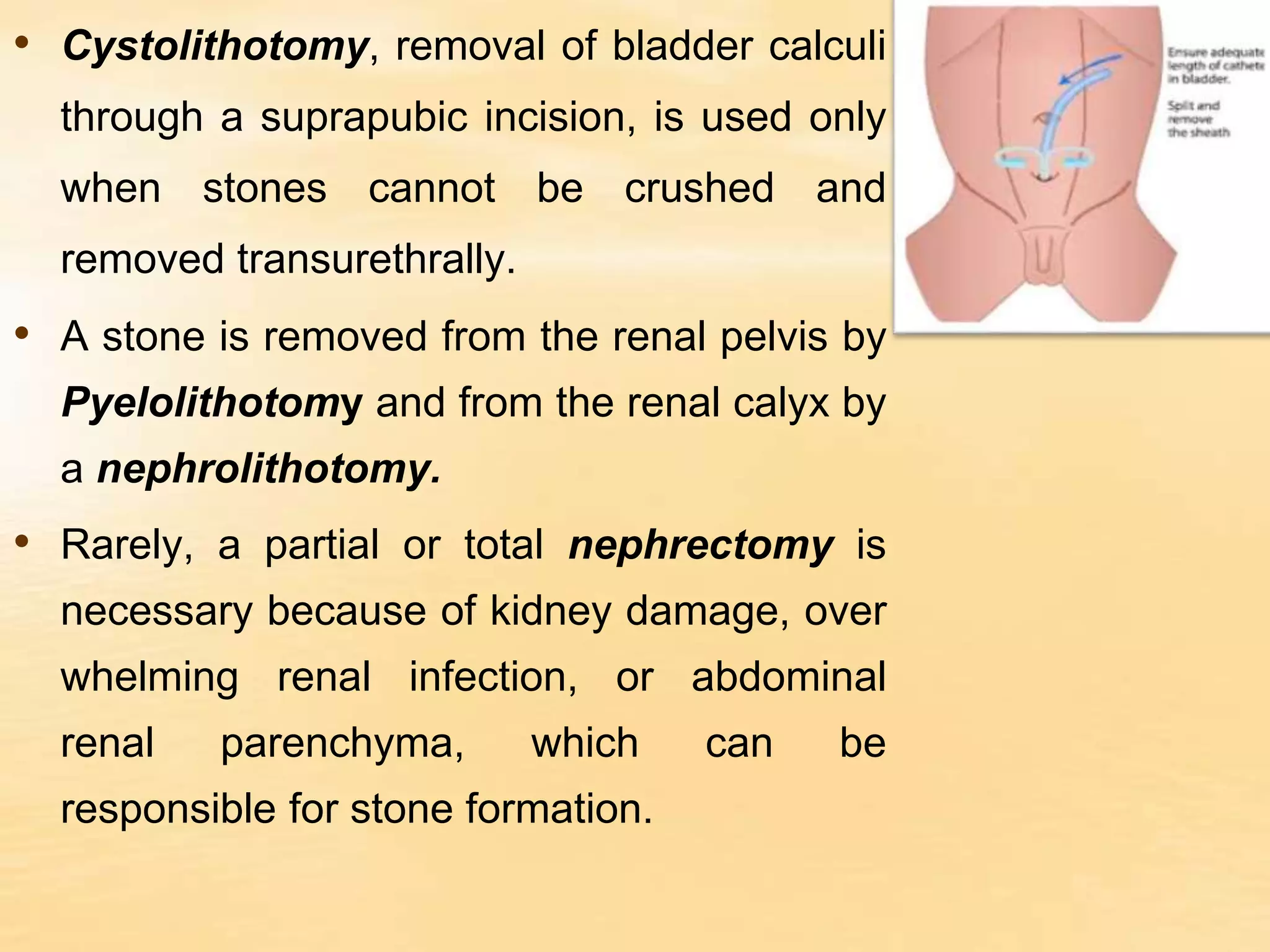 Renal calculi | PPTX