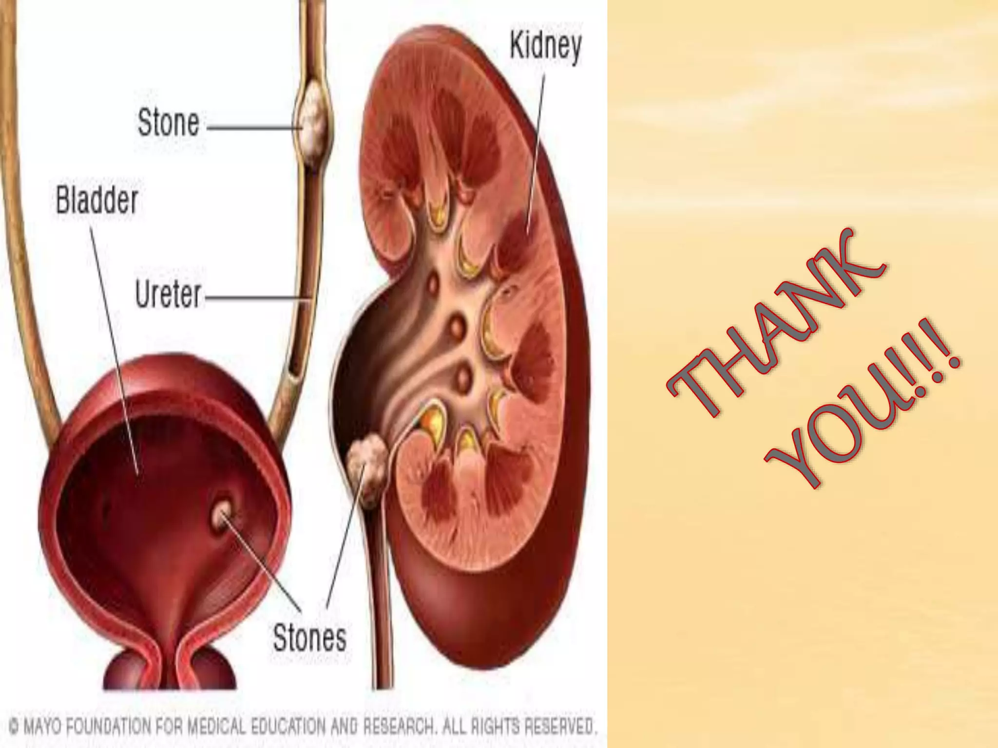 Renal calculi | PPTX