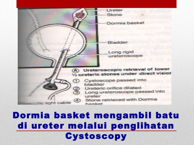 RENAL CALCULI - Batu karang dalam salur kencing | PPT