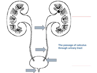 Renal calculi and hydronephrosis | PPT