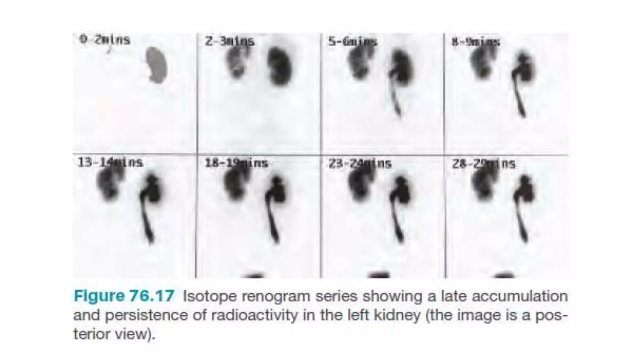 Renal calculi and obstructive uropathy.pptx