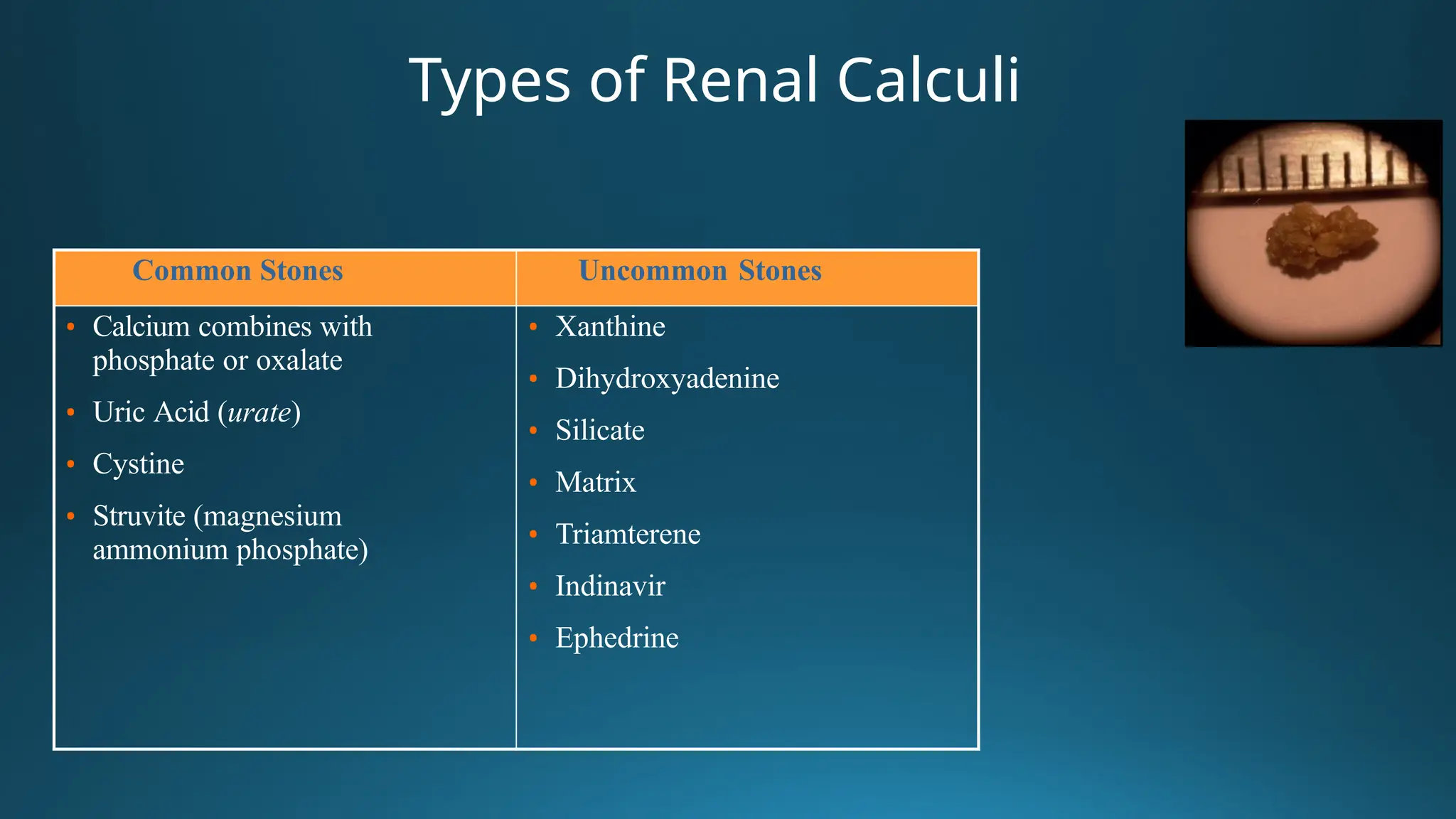 different Renal calculi types and its management | PPTX
