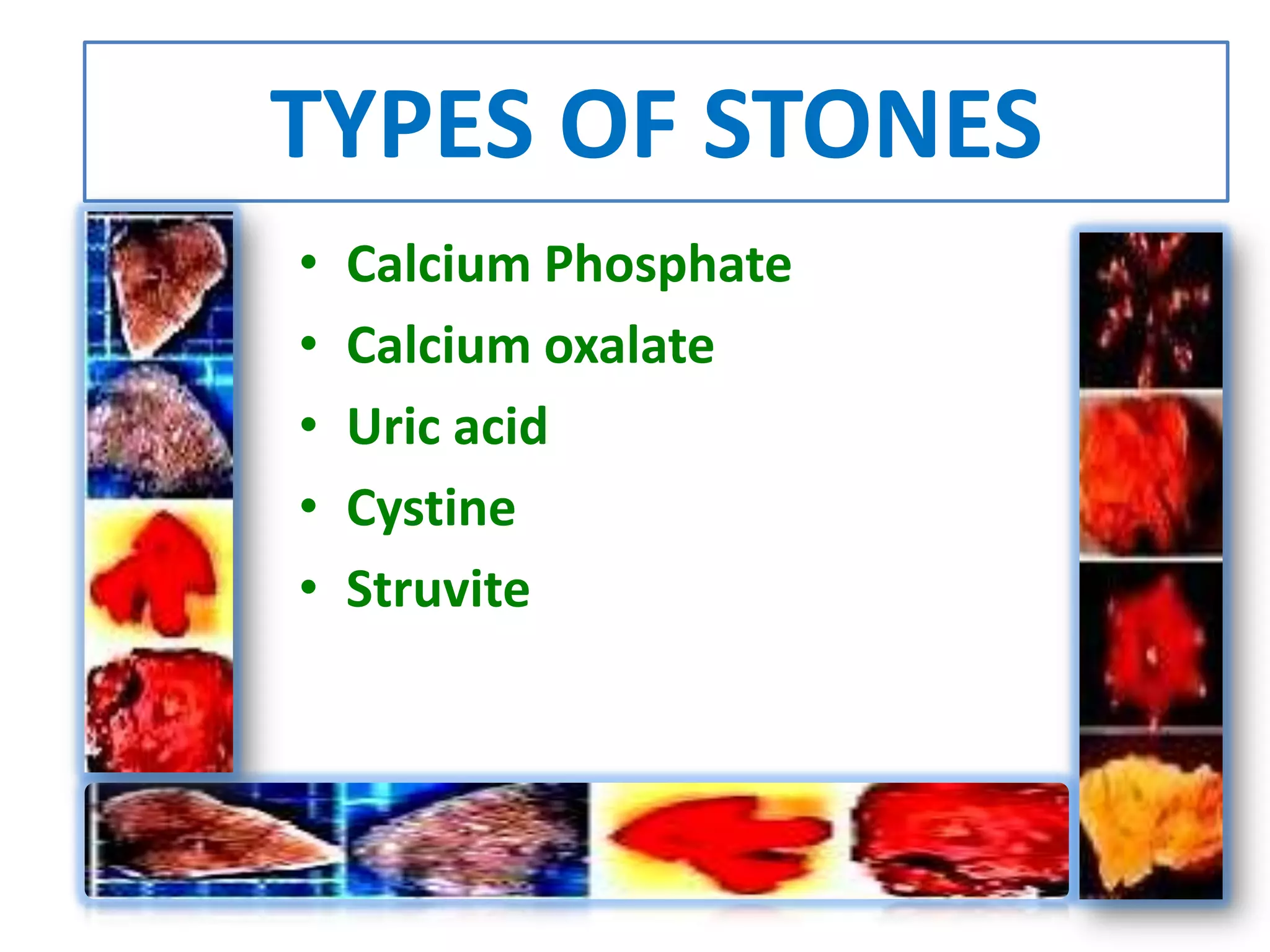 Renal calculi ppt | PPTX